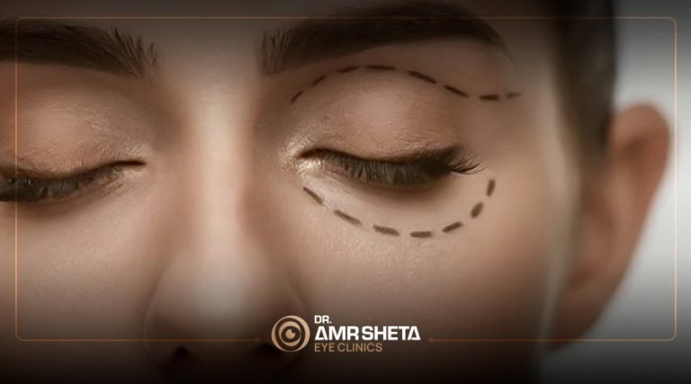 Blepharoplasty – Dr. Amr Sheta